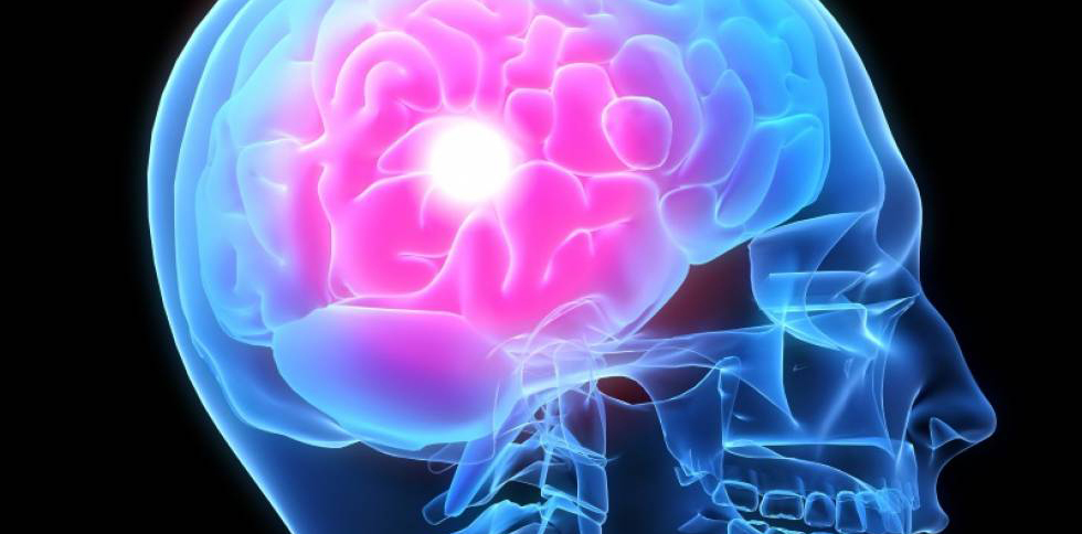Ictus IsquÉmico O Isquemia Cerebral